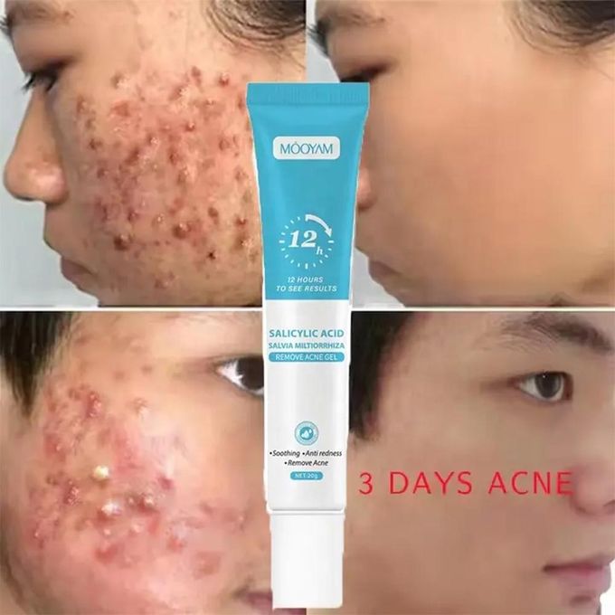 Generic Gel Anti-Acné Salicylic Acid – Soin Visage Anti-Boutons et Anti ...